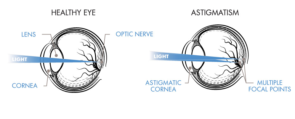 What is Astigmatism - Symptoms & Treatments | LensCrafters